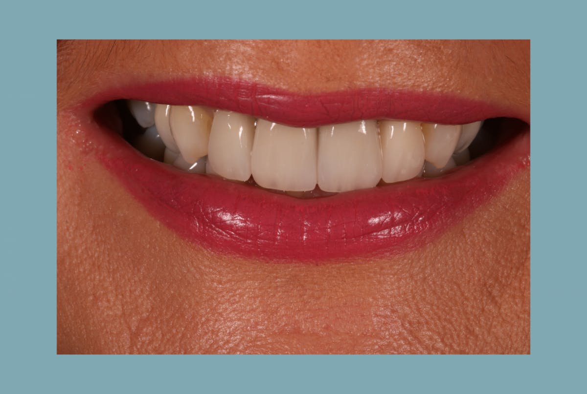 Multiple Dental Implants Multiple Dental Implants