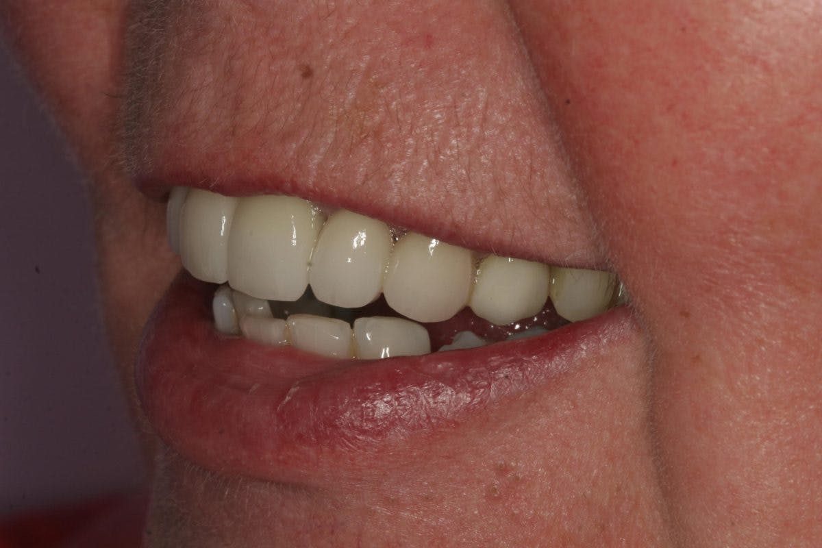 Discoloured Smiles | The Smile Spa