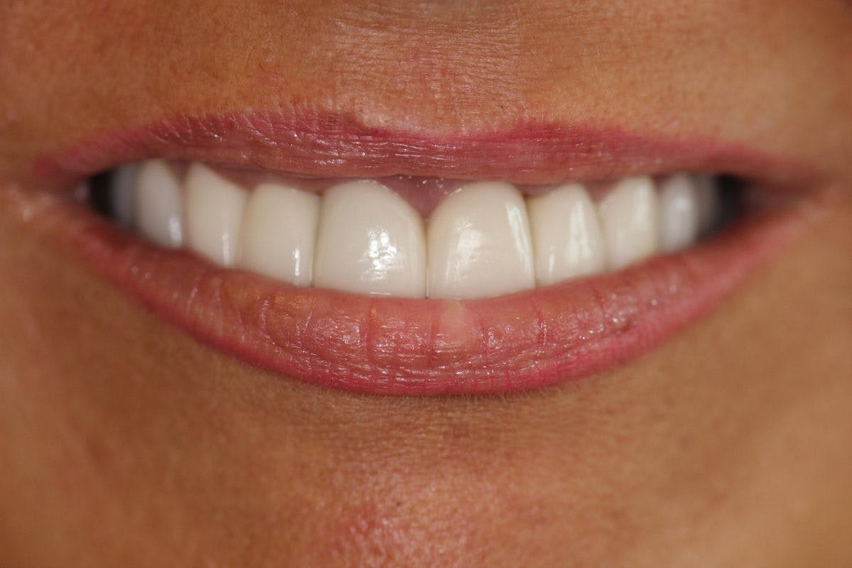 Personalised Smiles | The Smile Spa