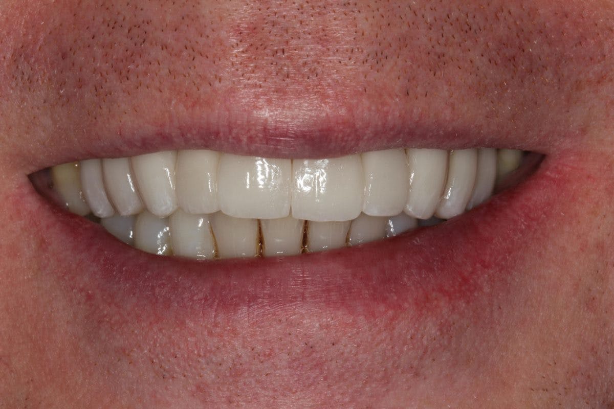 Crooked and Uneven Smiles | The Smile Spa, Stockton