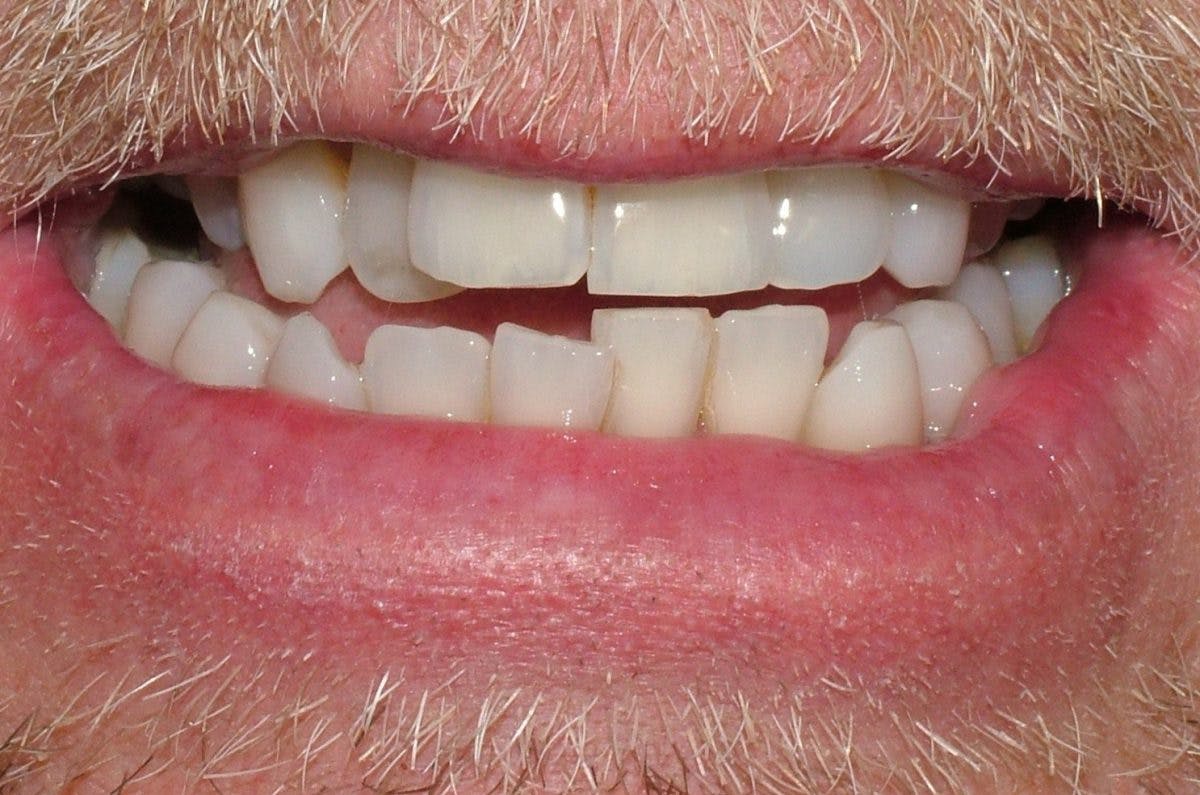 Crooked and Uneven Smiles | The Smile Spa, Stockton