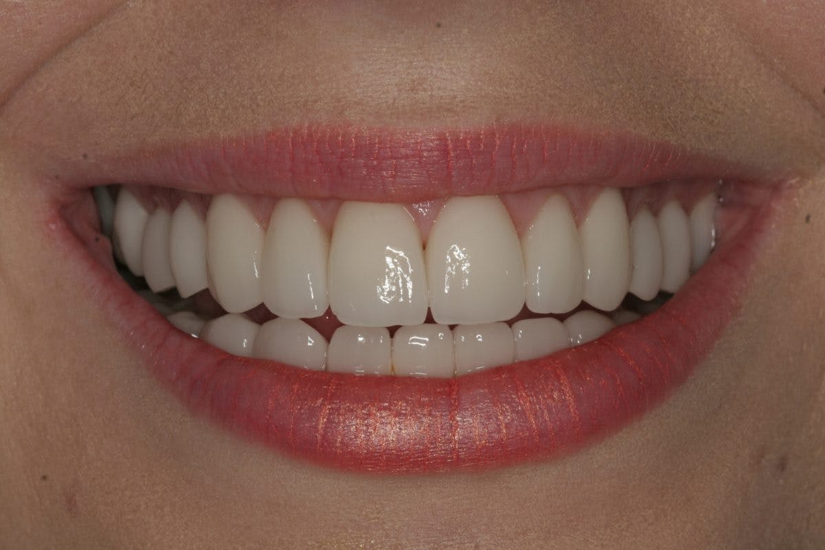 Discoloured Smiles | The Smile Spa