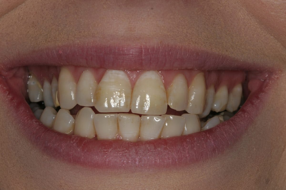 Discoloured Smiles | The Smile Spa