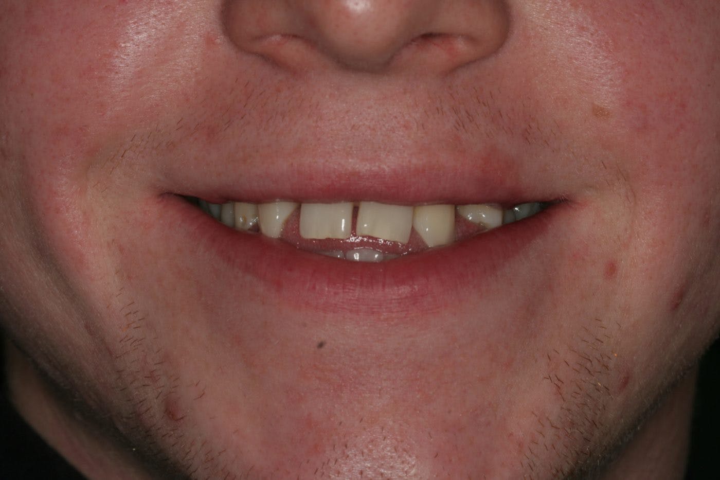 Gappy Smiles | The Smile Spa