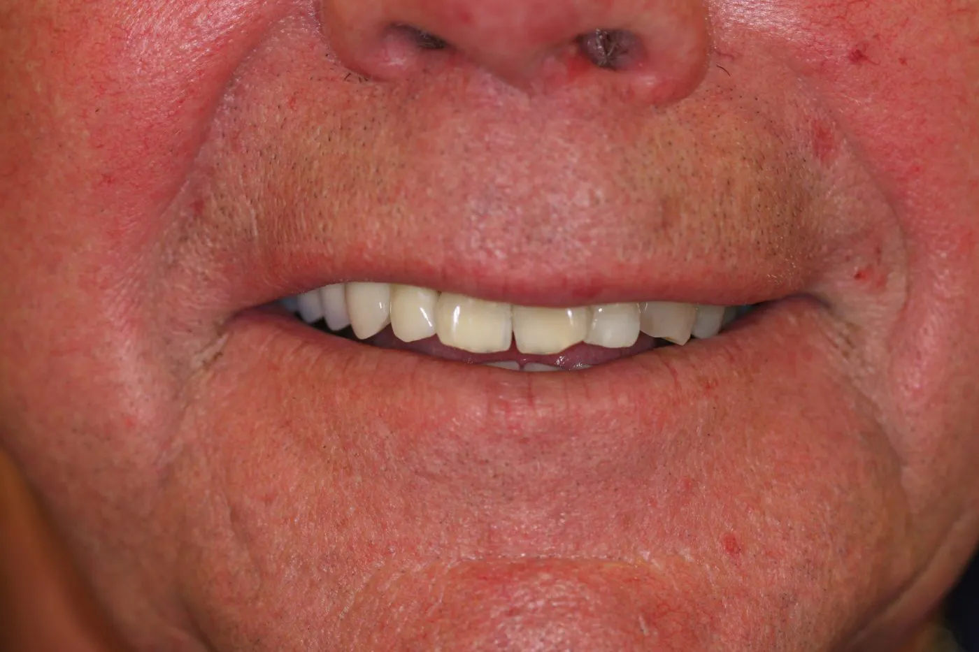 Dentures | The Smile Spa