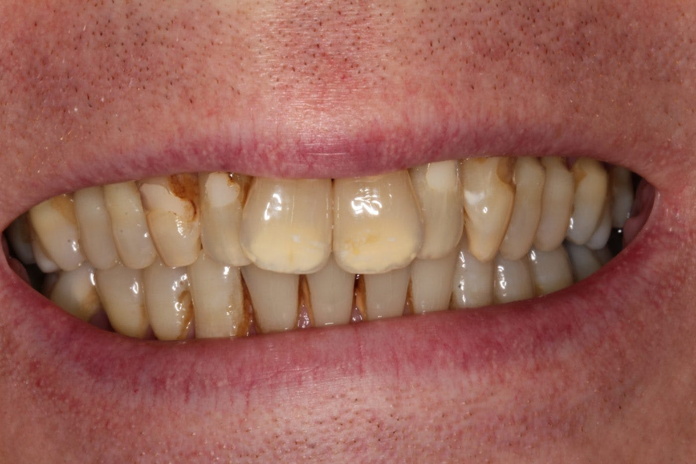 Teeth Straightening | The Smile Spa